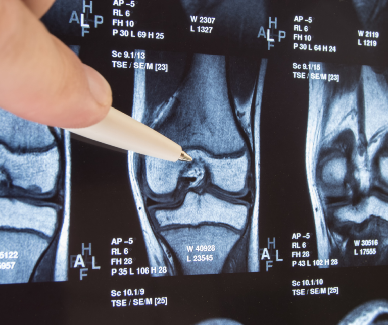What To Do About Bone-On-Bone Knee Pain